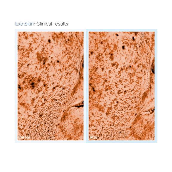 INNO EXOMA® EXO-SKIN – XTETIC