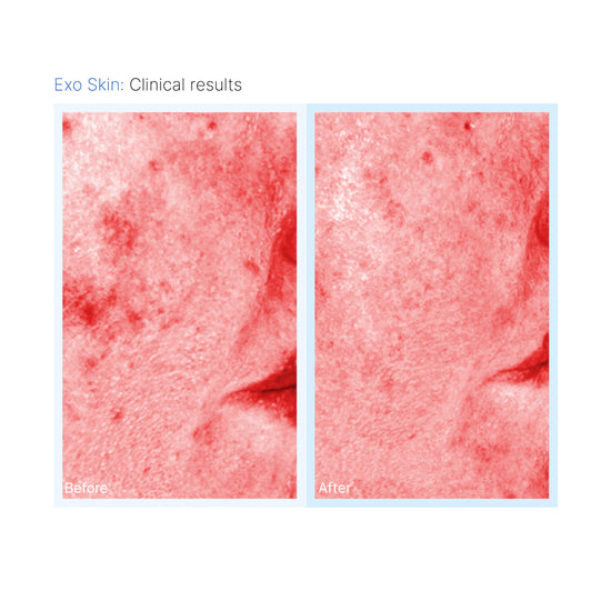 INNO EXOMA® EXO-SKIN – XTETIC